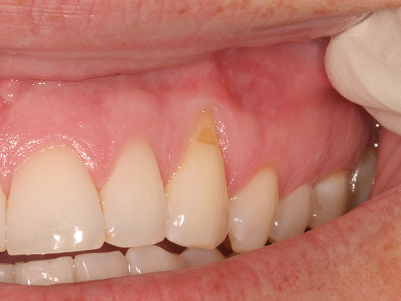 Gum Treatment Before and After Photos Jupiter Palm Beach Gardens FL