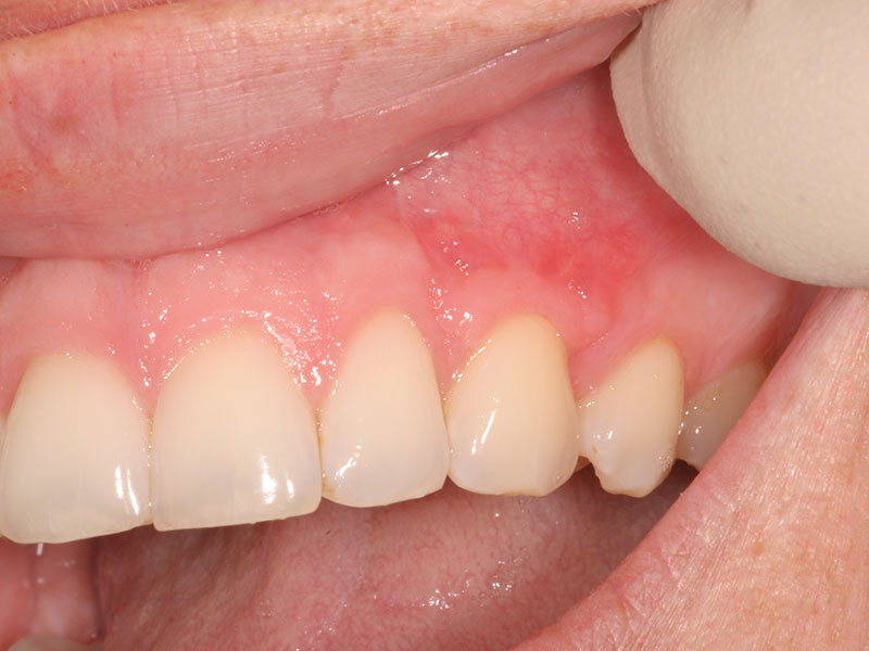 Gum Treatment Before and After Photos Jupiter Palm Beach Gardens FL