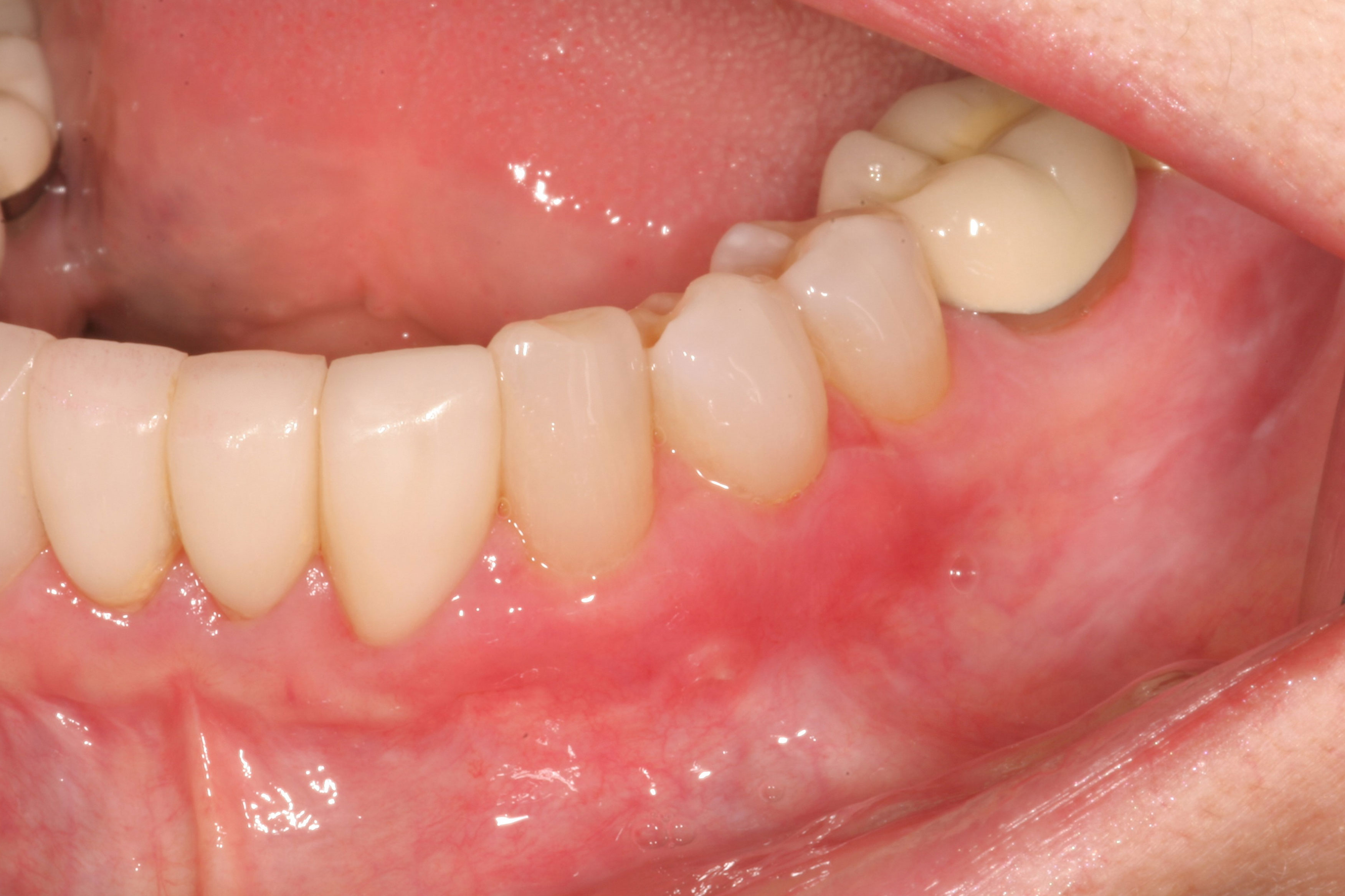Gum Treatment Before and After Photos Jupiter Palm Beach Gardens FL